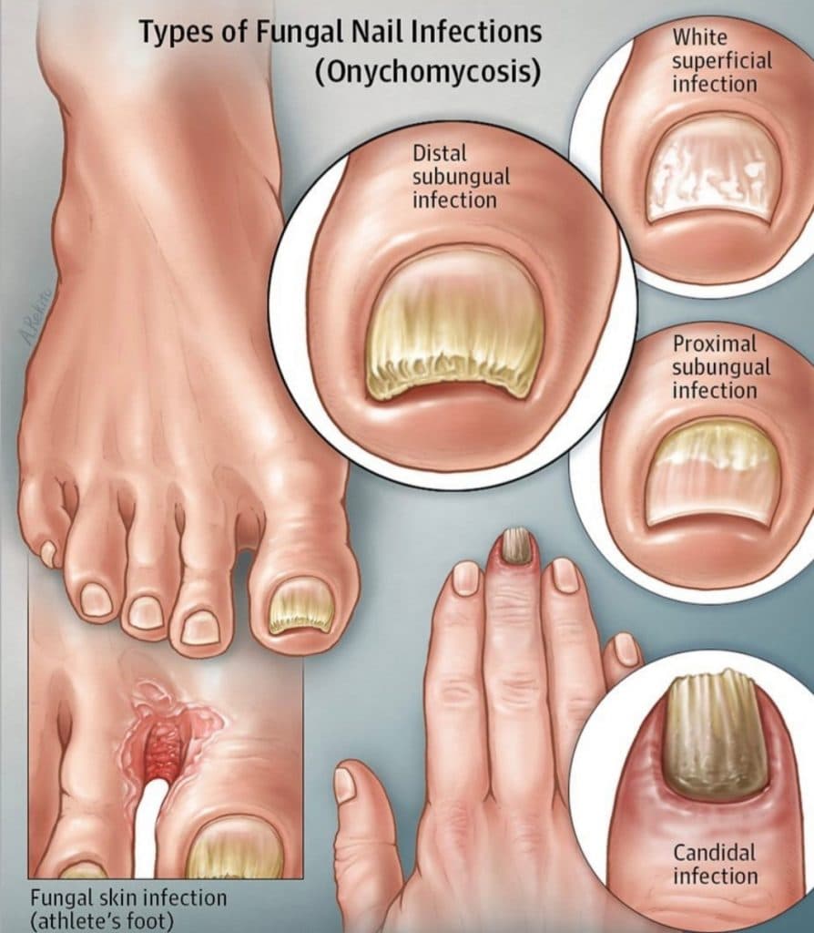 Onychomycosis and Homoeopathic Therapeutics | HDS